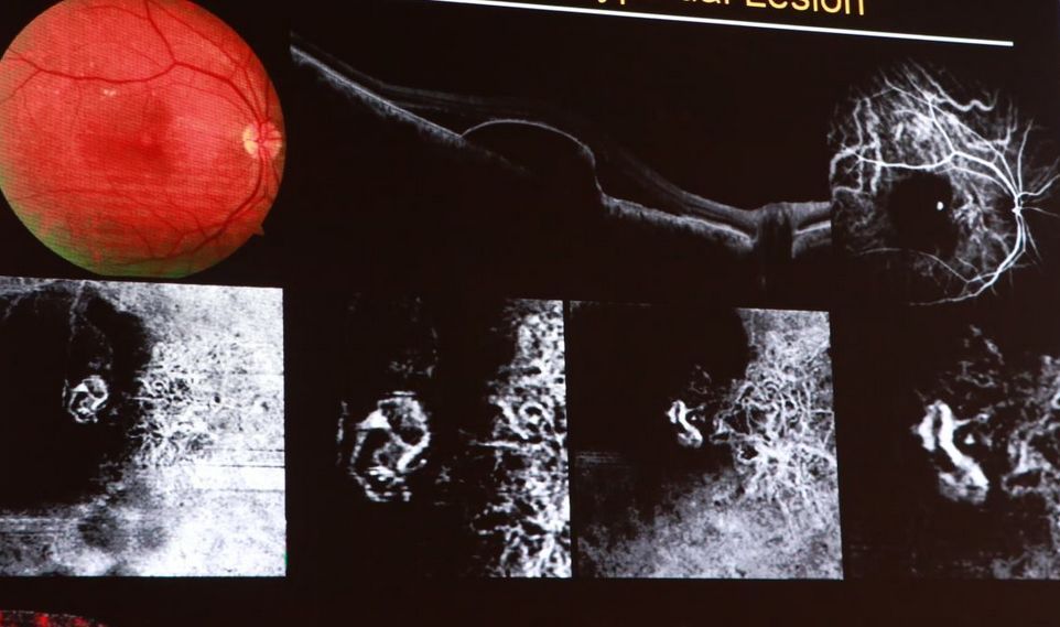 pfv和php,【Retina China 2019】工欲善其事必先利其器——影像学在眼底病中的应用与发展...-CSDN博客