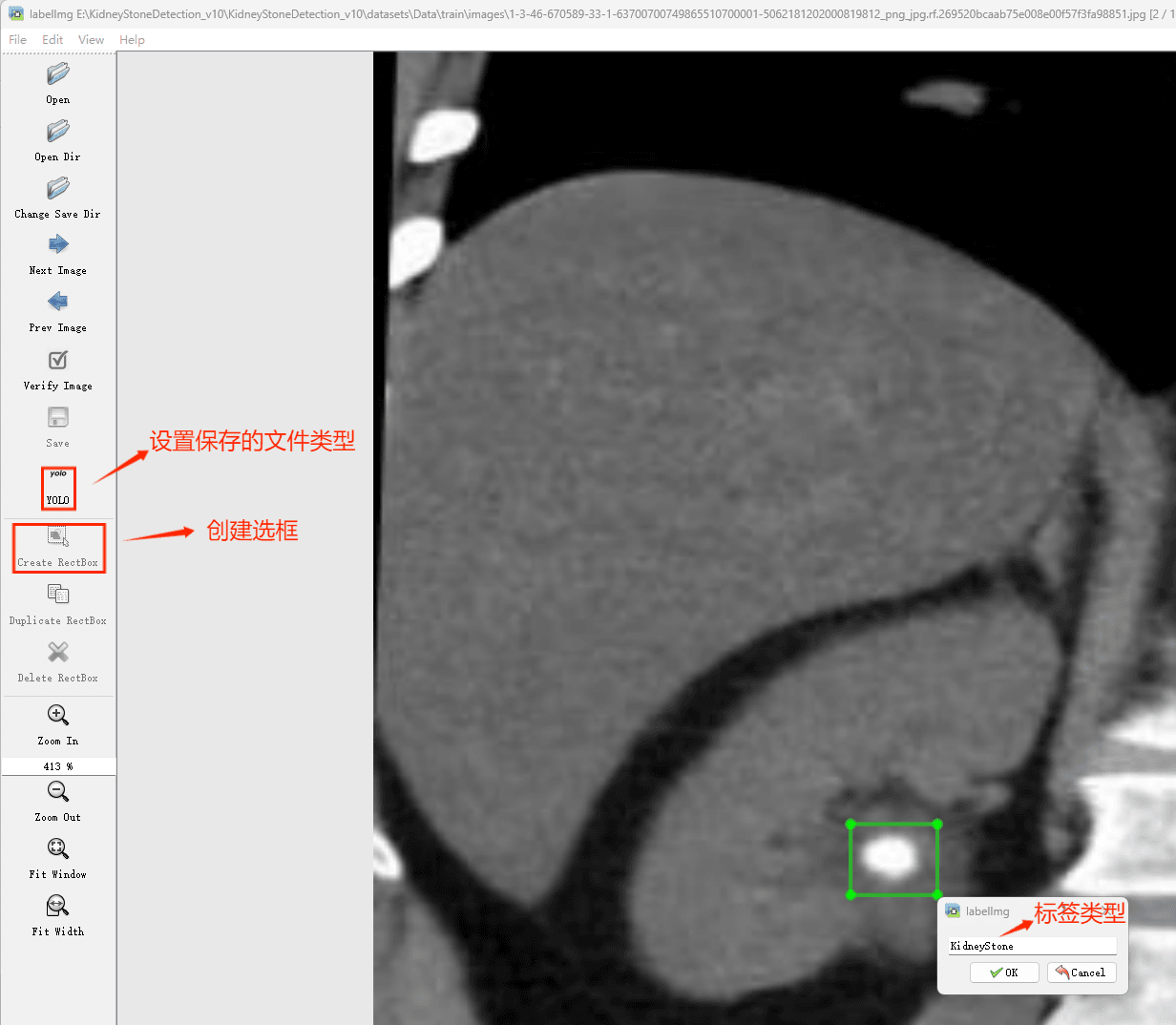 基于YOLOv10深度学习的医学影像CT图像肾结石检测系统研究与实现(PyQt5界面+数据集+训练代码)_深度学习结石自动诊断系统-CSDN博客