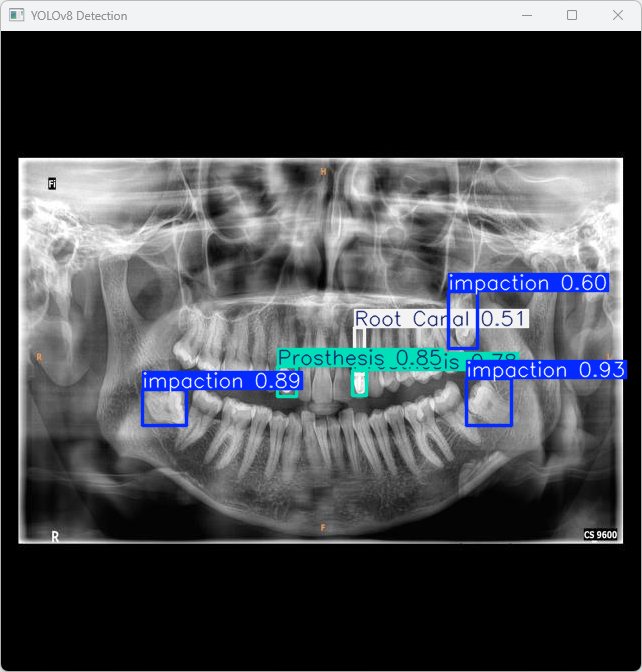 基于yolov8深度学习的智慧医疗口腔牙齿ct影像检测系统pyqt5界面数据集训练代码基于深度学习的口腔医学影像 Csdn博客