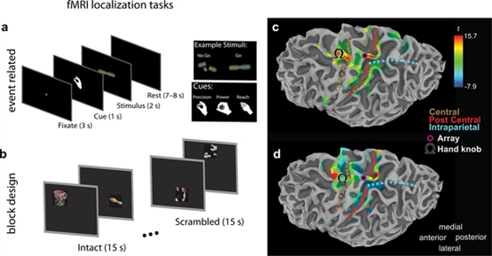 加州理工：BCI分析多年四肢瘫痪患者的神经信号表征和健康人一致-CSDN博客