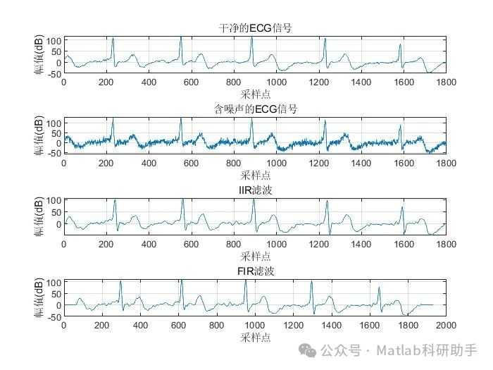 【心电信号】基于IIR和FIR滤波器实现心电图信号去噪附Matlab代码_陷波器实现fir实现-CSDN博客