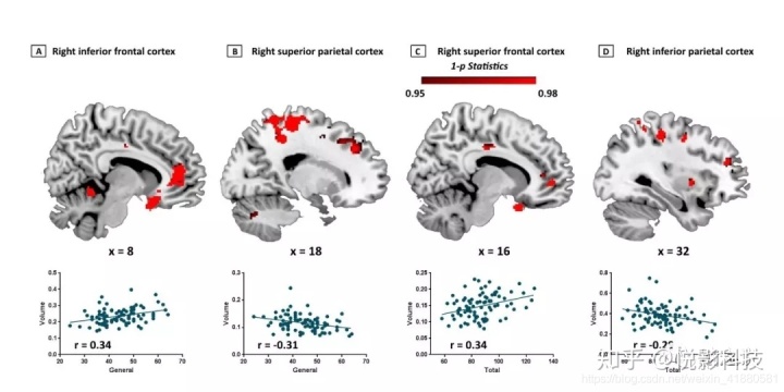 vbm 分析_不同的工具包对Voxel-based morphometry (VBM)计算结果的影响-CSDN博客