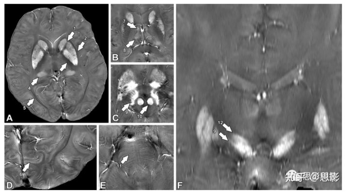 磁敏感定量成像技术的基本方法和临床应用_qsm-CSDN博客