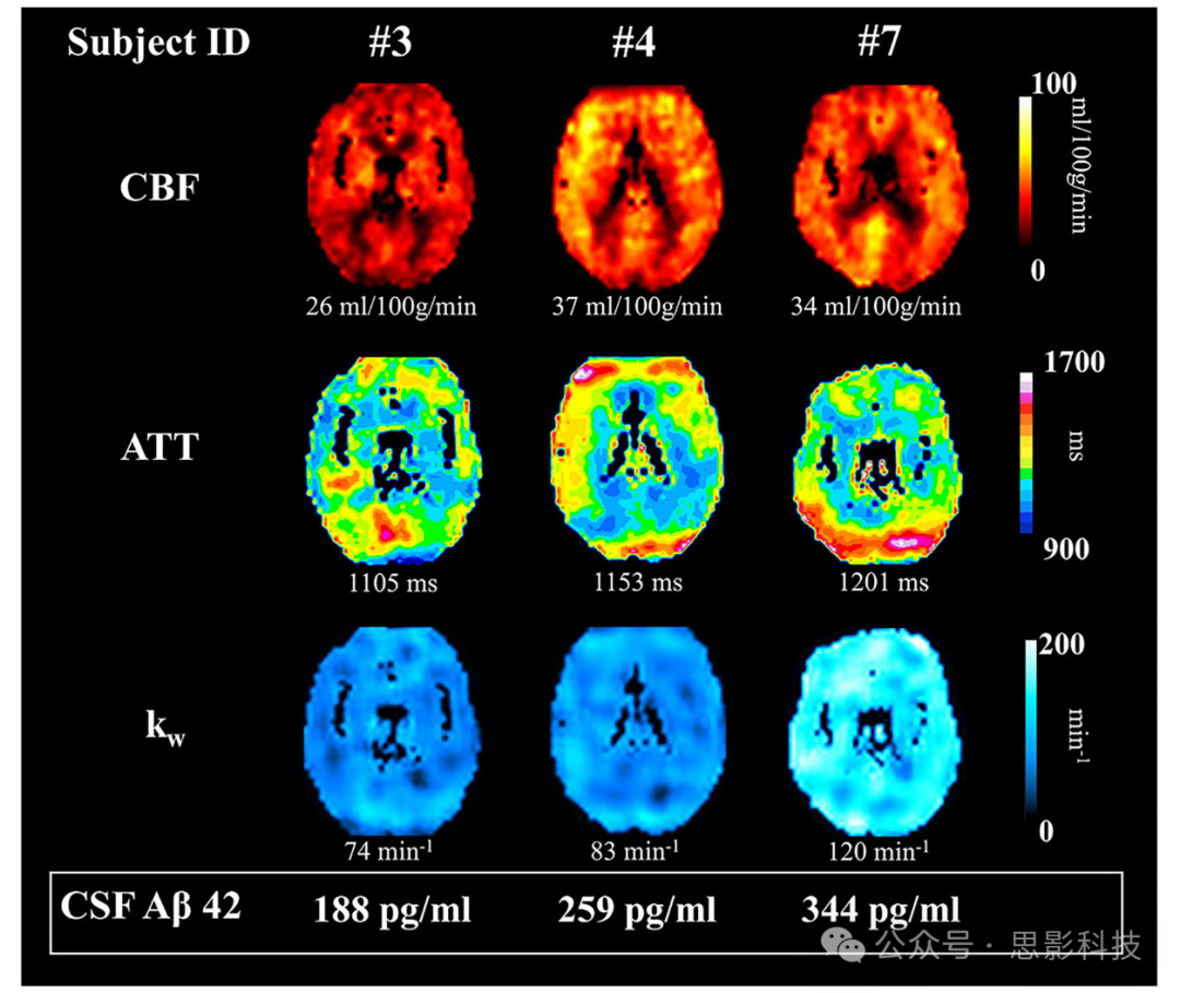 磁共振成像评估脑淋巴系统活性_dti alps-CSDN博客