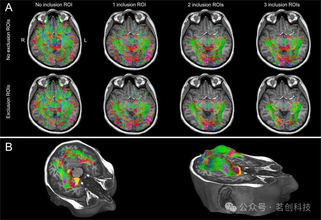 基于扩散MRI的连接_dti序列是dmri吗-CSDN博客