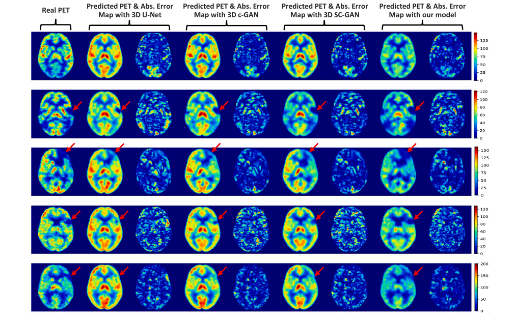 将脑部磁共振成像（MRI）转化为诊断用正电子发射断层扫描（PET）：通过基于注意力的编码器-解码器网络从多对比度MRI合成15O-水PET脑血流量（CBF）。|文献速递-基于生成模型的数据增强 ...
