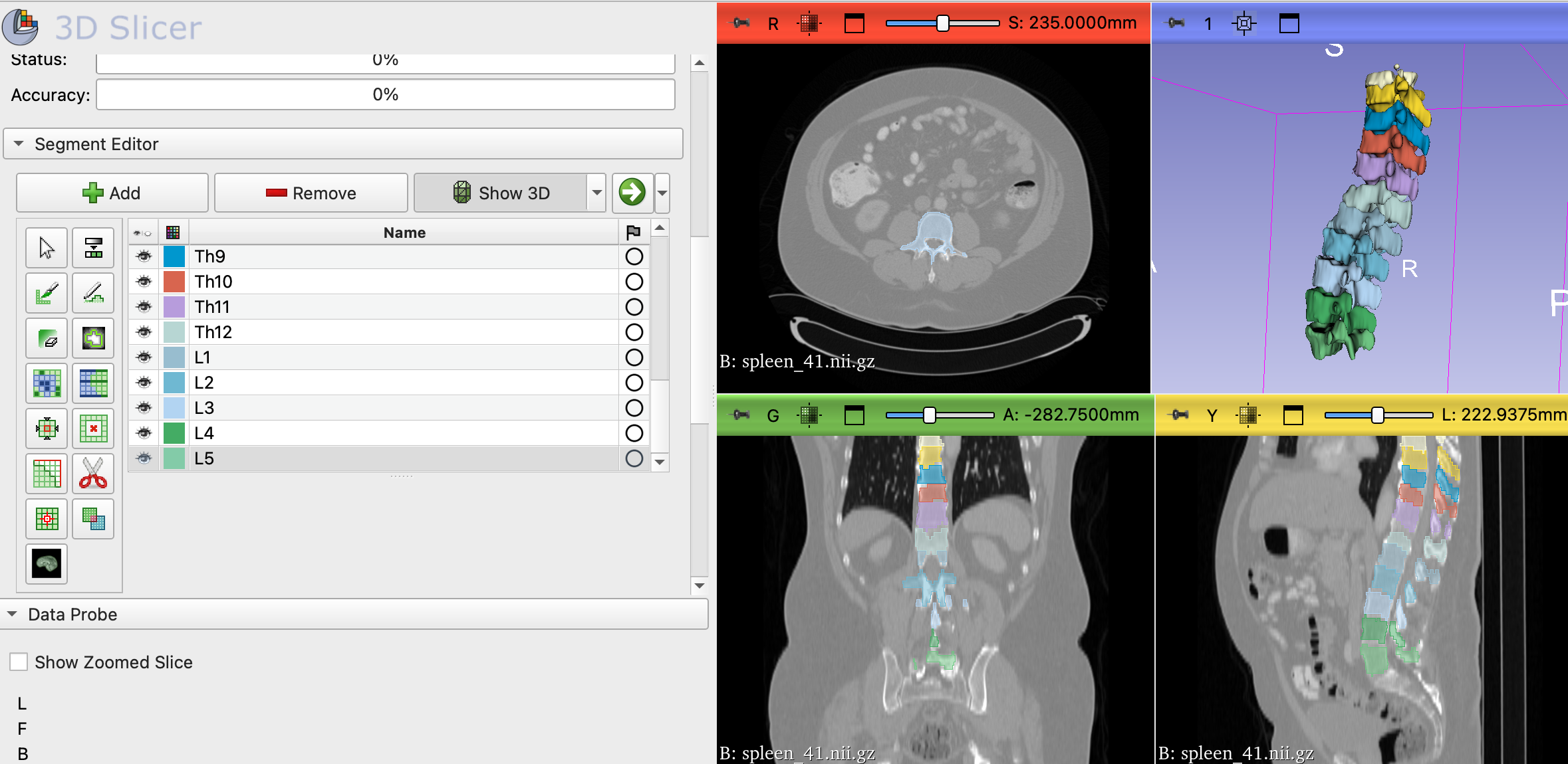 MONAILabel in 3D Slicer 案例2: 脊柱全段分割-CSDN博客