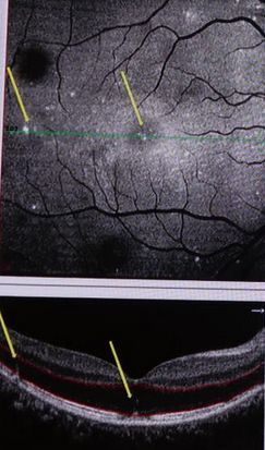 pfv和php,【Retina China 2019】工欲善其事必先利其器——影像学在眼底病中的应用与发展...-CSDN博客