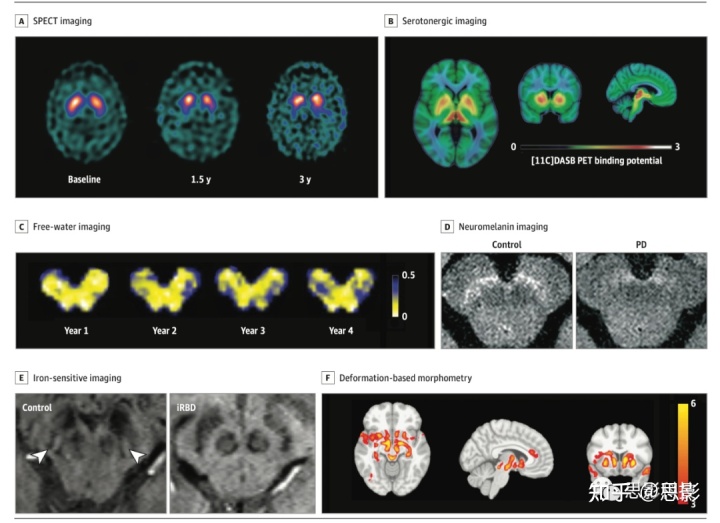 JAMA Neurology：帕金森病不同疾病阶段的神经影像学生物标志物_pbmc在帕金森病早期诊断中的应用-CSDN博客