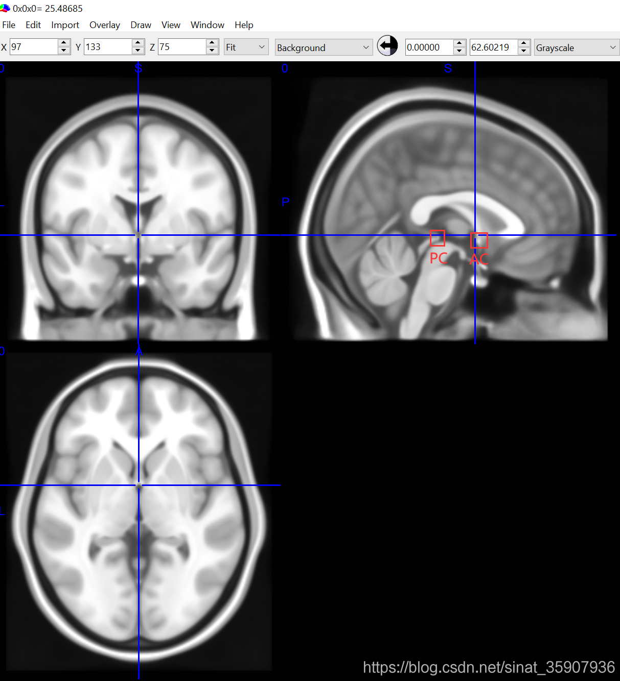 vbm 分析_MRI脑影像分析从哲学到技术：一文搞懂VBM预处理基本原理（全网最详细解析）..._weixin_39742392的博客-CSDN博客