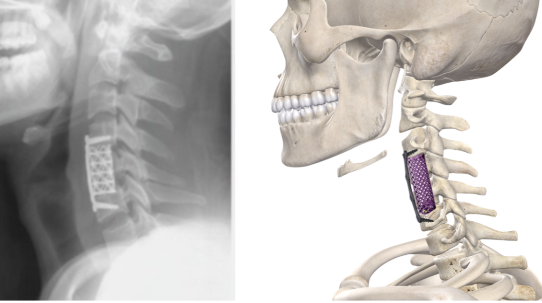 adf的主要功能之一是_ADF颈椎前路减压融合术(anterior decompression and fusion)_weixin_39768247的博客-CSDN博客