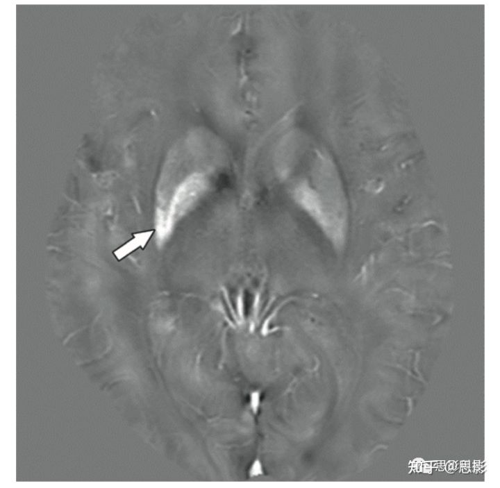 磁敏感定量成像技术的基本方法和临床应用_qsm-CSDN博客