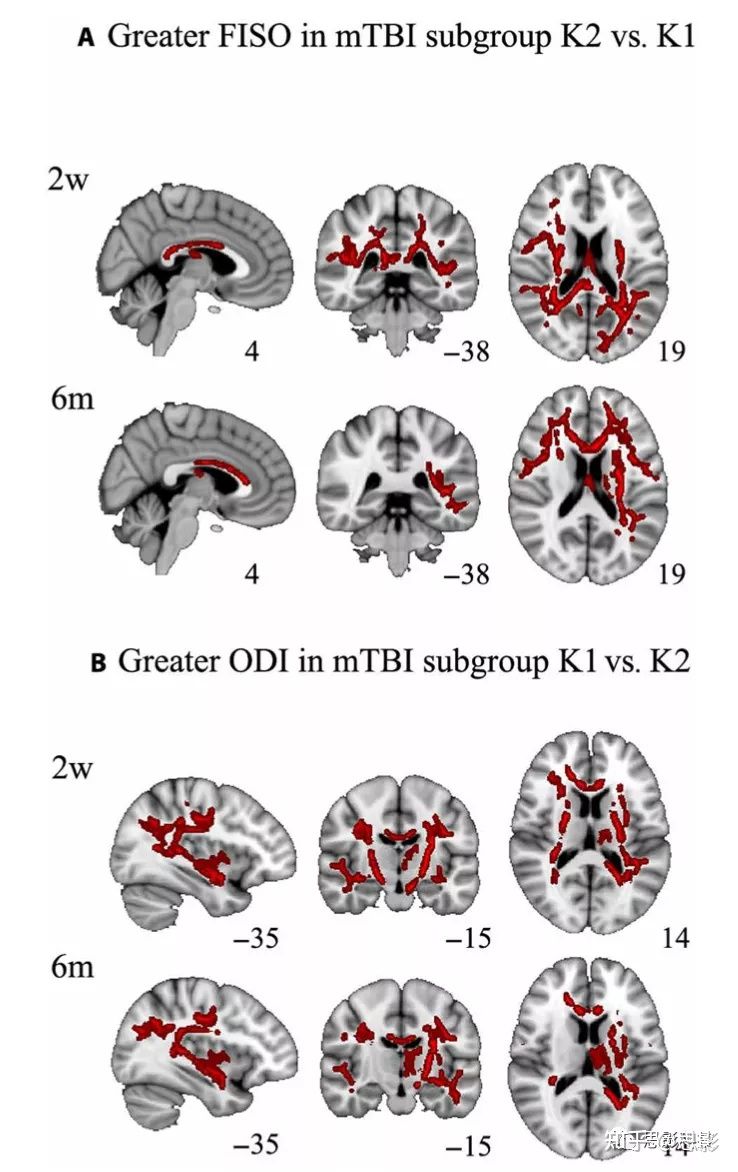 Science子刊：利用DTI和NODDI纵向研究揭示轻度脑外伤后的白质微结构改变_dti noddi等优劣势-CSDN博客