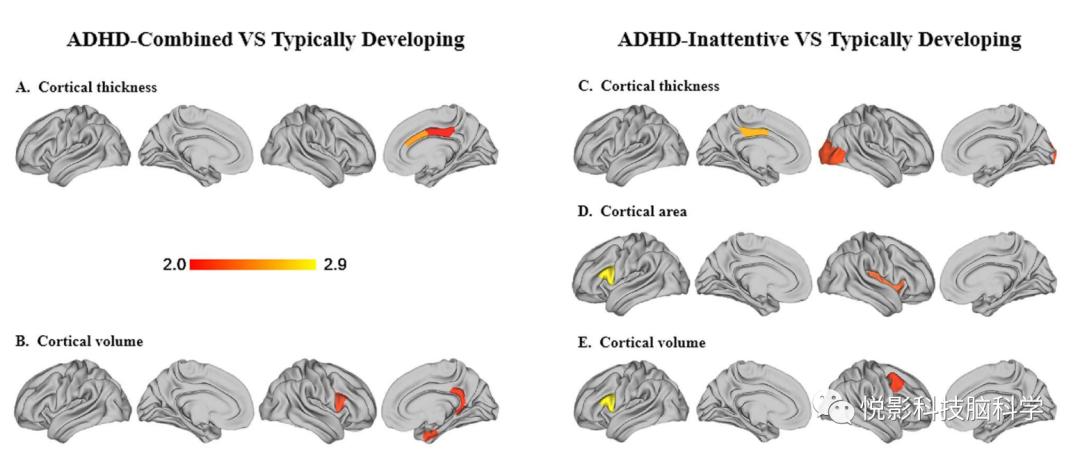儿童多动症亚型的脑结构改变和相关症状_adhd数据集-CSDN博客