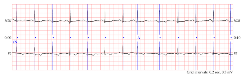 MIT-BIH介绍（二）什么是MIT-BIH？-CSDN博客