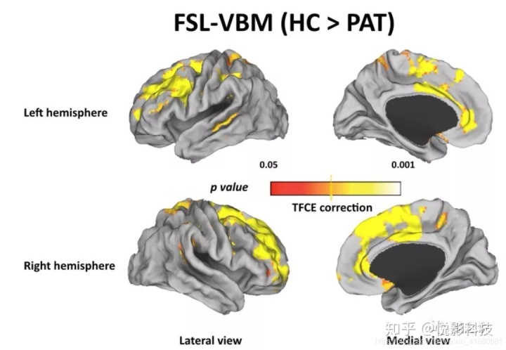 vbm 分析_不同的工具包对Voxel-based morphometry (VBM)计算结果的影响-CSDN博客