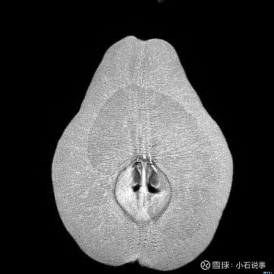 ct计算机断层扫描原理通俗,一张图告诉你：MRI、CT、X-ray的区别-CSDN博客