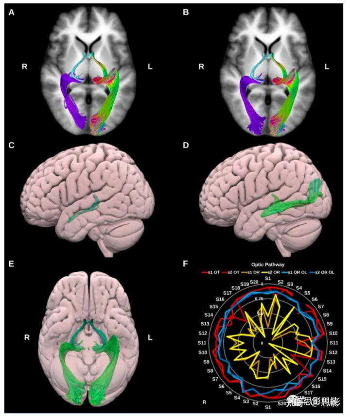 基于约束球面反卷积扩散磁共振的脑白质解剖图谱-CSDN博客