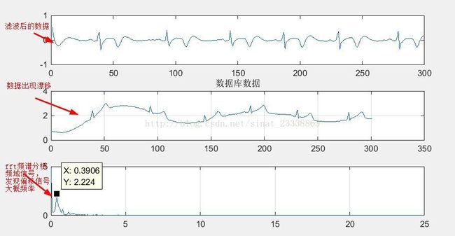 ecg去噪 matlab,基于matlab对ECG信号进行滤波处理-CSDN博客