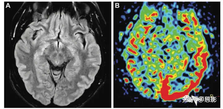 动脉自旋标记：技术、临床应用和解释_asl的rcbf(相对灌注量)和绝对cbf(绝对灌注量)预处理-CSDN博客
